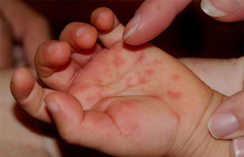 HFMD disease: a dilemma for health authorities | Health | SGGP English ...